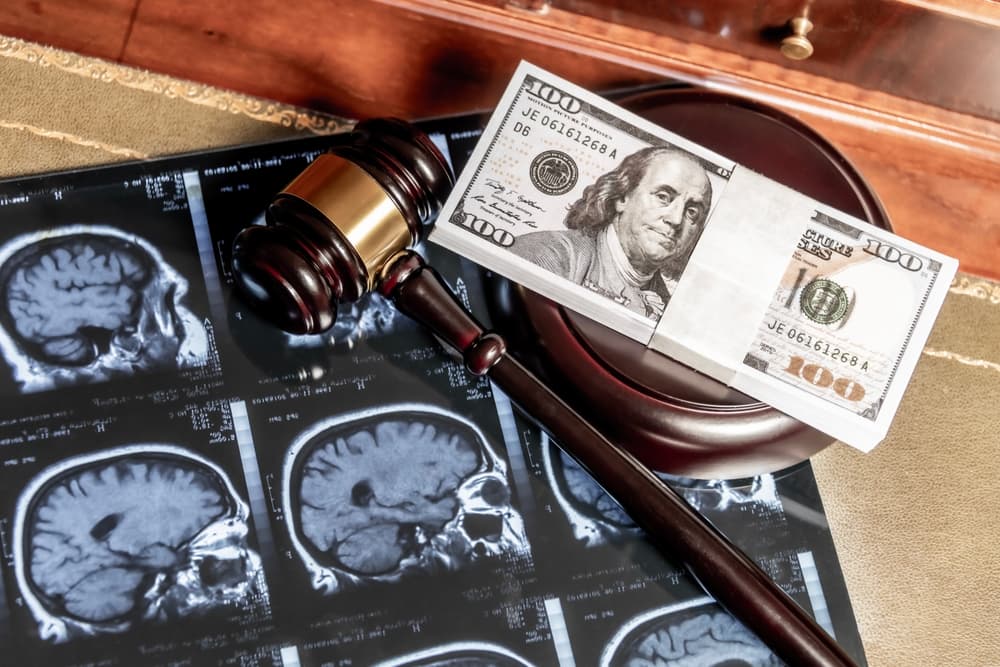 How Long Does a Brain Injury Claim Take? - Varner Elite Legal